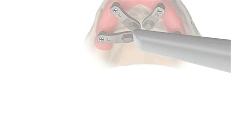 Photogrammetry Systems Aa Dental Design Photogrammetry Systems Aa Dental Design