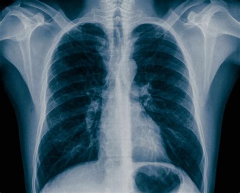 Ai Can Predict The Risk Of Heart Disease By Analysing A Single Chest X