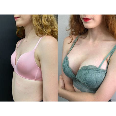 34c Implants