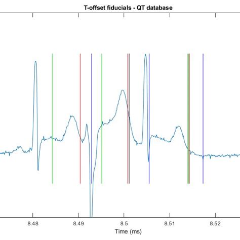 Ecg Extract From Qt Database Showing The T Offset Detection Points From Download Scientific