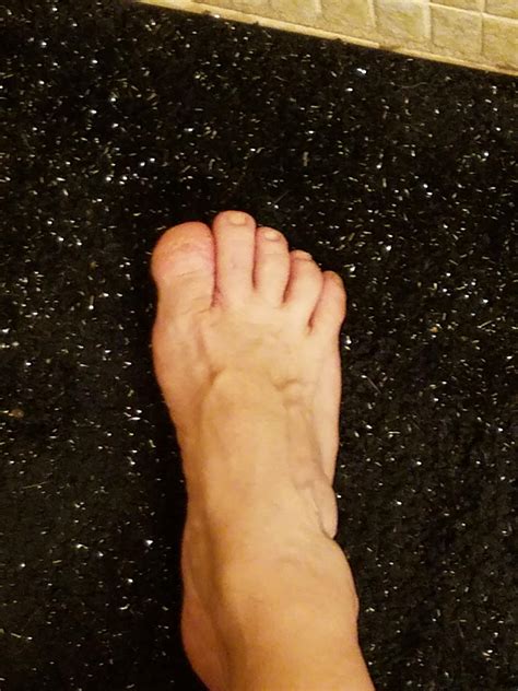 In Trying To Save A Life The Great Toe Had To Be Partially Amputated After It Was Crushed By A