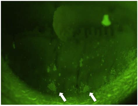Superficial Punctate Keratitis