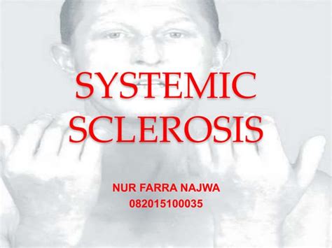 I Am Sharing Systemic Sclerosis With You Pptx