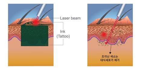 레이저 문신 제거의 원리 및 치료과정