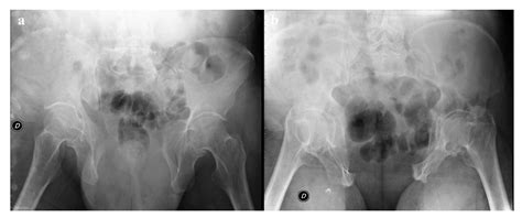 Pelvic Fracture X Ray