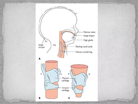 Pediatric Airway Management Pptx