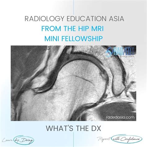 Mri Hip Cam Fai Femoro Acetabular Impingement Radedasia