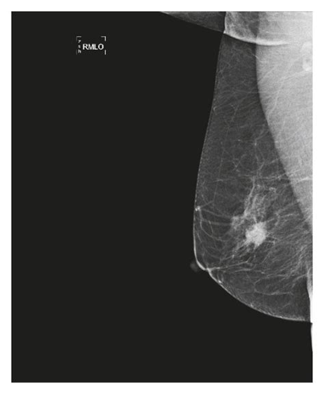 The Mammogram Data With Different Views And Corresponding Annotations Download Scientific