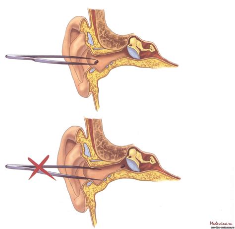 Застряла Вата В Ухе Что Делать 56 Фотo