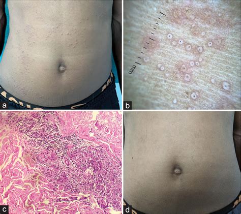 Clinicodermoscopic Features Of Lichen Scrofulosorum A Rare Form Of Cutaneous Tuberculosis