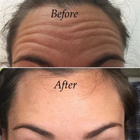 Wrinkle Reduction Dermasecrets