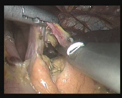 Dr Rahul Naiks Blog On Gastroenterology Gi Laparoscopic And