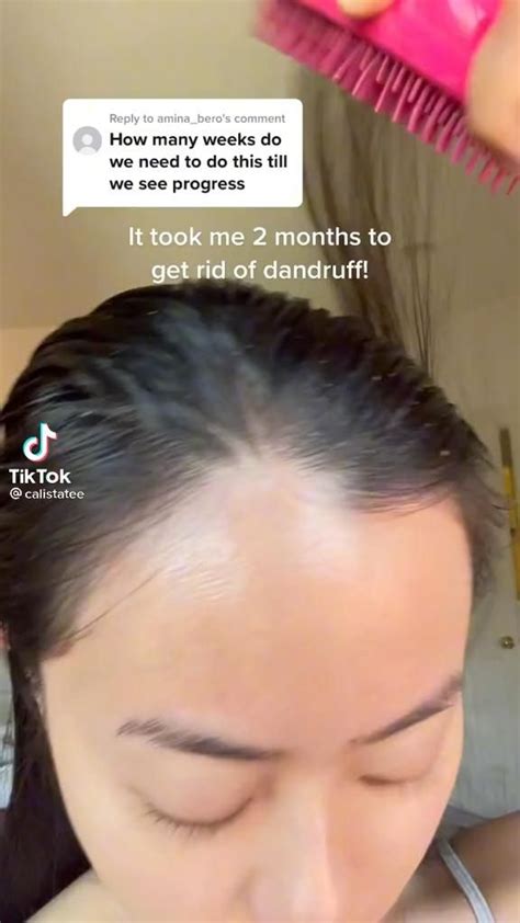 How To Treat Scalp Sores Emedihealth Artofit