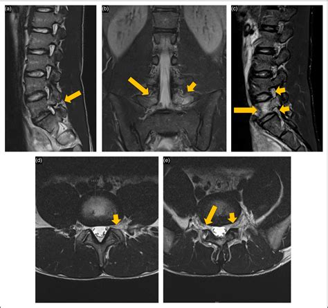 Figure 11 From Mr Imaging Differentiating Features Between Lytic And