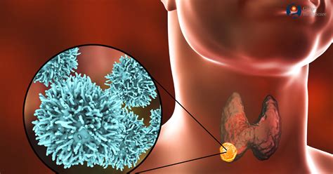Thyroid Cancer Causes Symptoms Diagnosis And Treatment Options