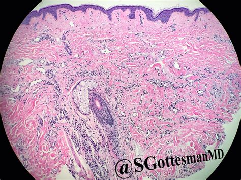 Microvenular Hemangioma Branching Jerad Gardner Md