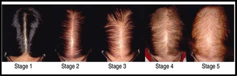 Decoding Female Pattern Hair Loss Fphl