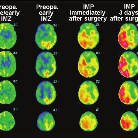 Continuous Monitoring Of Regional Cerebral Oxygen Saturation Rso 2 Download Scientific