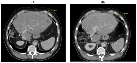 Comprehensive Examination Of Cholangiocarcinoma Patients Treated With Novel Targeted Therapies