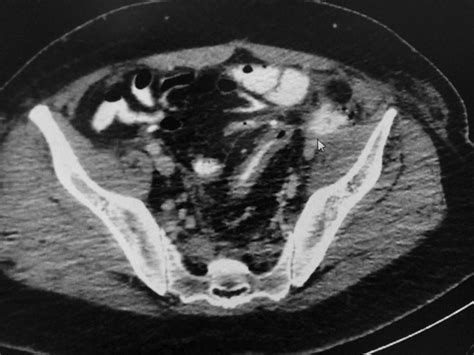 Sagittal Ct Showing Fluid Collection Seen In The Left Iliac Fossa Download Scientific Diagram