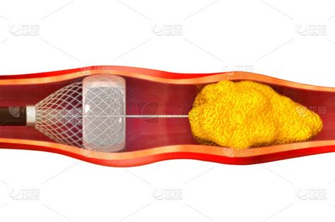 血管成形术 内支架 心血管系统 人类心脏 胆固醇 心脏病专家 三维图形 心肌梗塞 动脉硬化症 健康保健