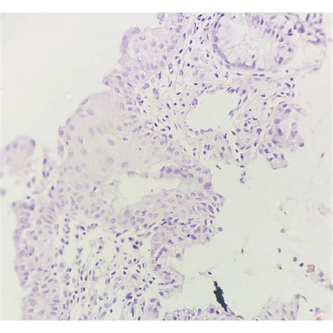A Cervical Biopsy Initial Section Showing Strips Of Ectocervical
