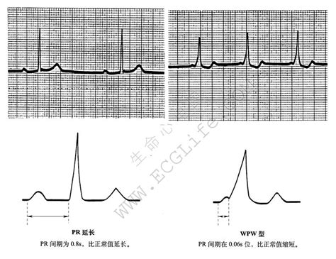 附图PR延长 心电图学 天山医学院