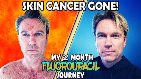 Fluorouracil Skin Cancer Treatment On Face And Chest Youtube