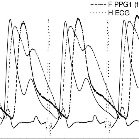 The Baseline Removed Normalized Pulse Waves Emfi Left Wrist Solid