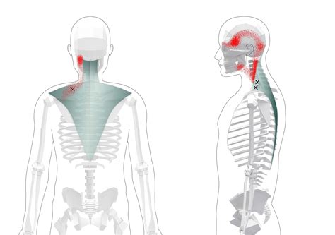 Upper Back Trigger Points Overview Tips And Exercises