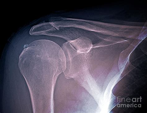 Calcific Tendinitis Photograph By Zephyr Science Photo Library Pixels