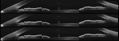 Evaluation Of Schlemm Canal Parameters Using Swept Source Op Eye
