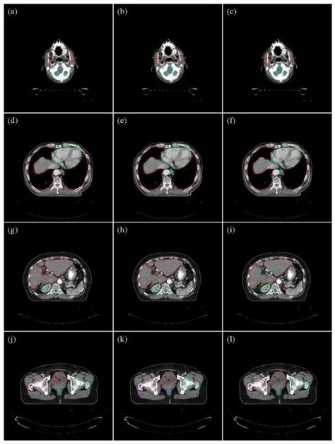 Oncosoft On Linkedin Automated Organ Segmentation For Radiation Therapy A Comparative Analysis…