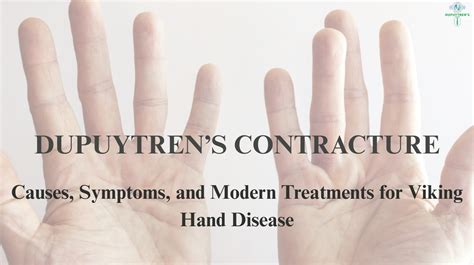 Dupuytrens Contracture Causes Symptoms And Modern Treatments For V