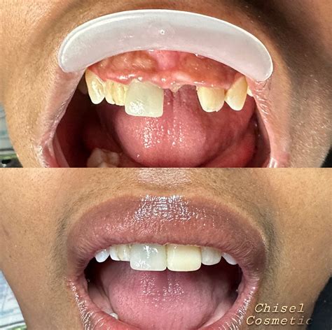 Chisel Cosmetic Midlothian Il