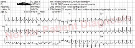 Deep Inverted T Waves Info In Comments EKGs