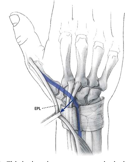 Figure From Proximal Row Carpectomy Semantic Scholar