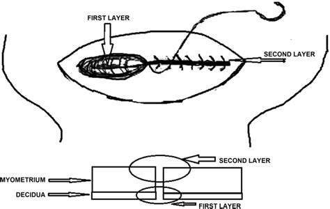 Illustration Of Double Layer Uterine Closure Technique Download Scientific Diagram