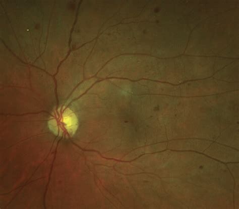 Diabetic Retinopathy And Machine Learning