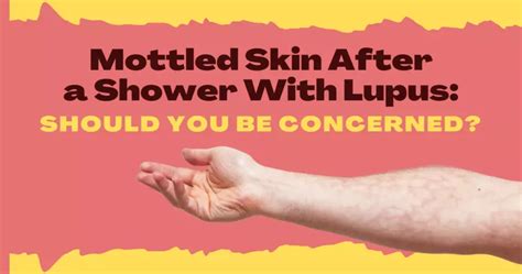 Mottled Skin After A Shower With Lupus Should You Be Concerned