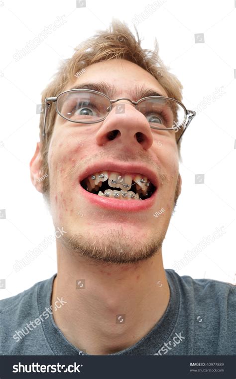 Man Showing His Braces Face Close Stock Photo Shutterstock