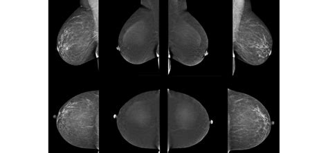 Representative Normal CEM Study With Standard Views Showing The Low Download Scientific