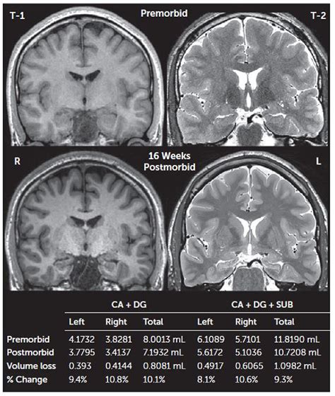 Figure 2 From An Opioid Related Amnestic Syndrome With Persistent Effects On Hippocampal