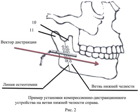 СПОСОБ ДЛЯ РАСШИРЕНИЯ ВЕТВИ НИЖНЕЙ ЧЕЛЮСТИ И КОМПРЕССИОННО ...