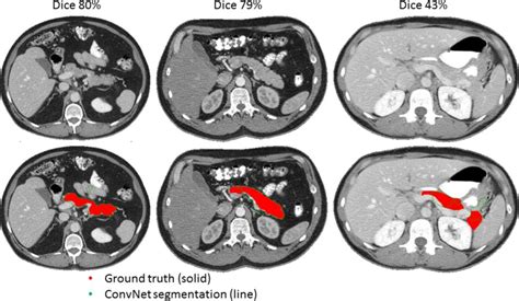 Deep Convolutional Networks For Pancreas Segmentation In Ct Imaging Deepai