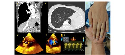 16 Year Old Female With Severe Unrepaired Chd Multiple Risk Factors At Download Scientific
