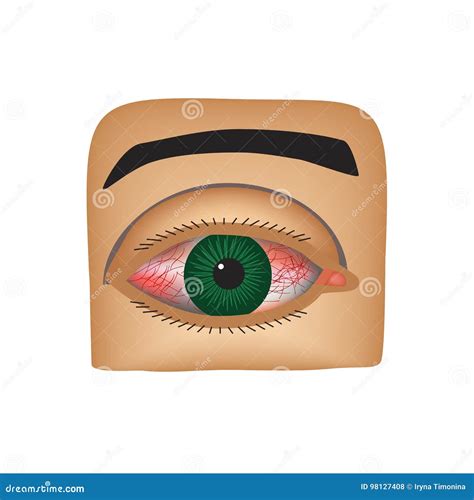 Conjunctivitis Redness And Inflammation Of The Eye Vessels Eye Drops Infographics Vector