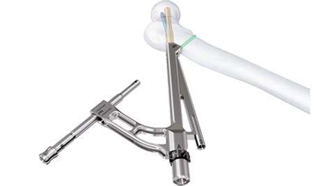 Femoral Neck System Trauma And Extremities Depuy Synthes Femoral Neck System Trauma And Extremities Depuy Synthes