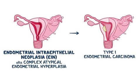 Endometrial Intraepithelial Neoplasia Hyperplasia And Carcinoma