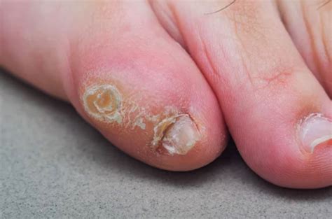 Pinky Toe Deformed
